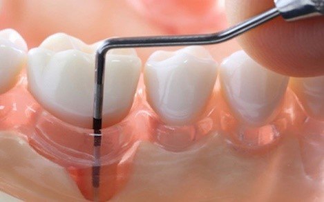 Back to the Basics: The Importance of a Prophy | Your Dentists in ...