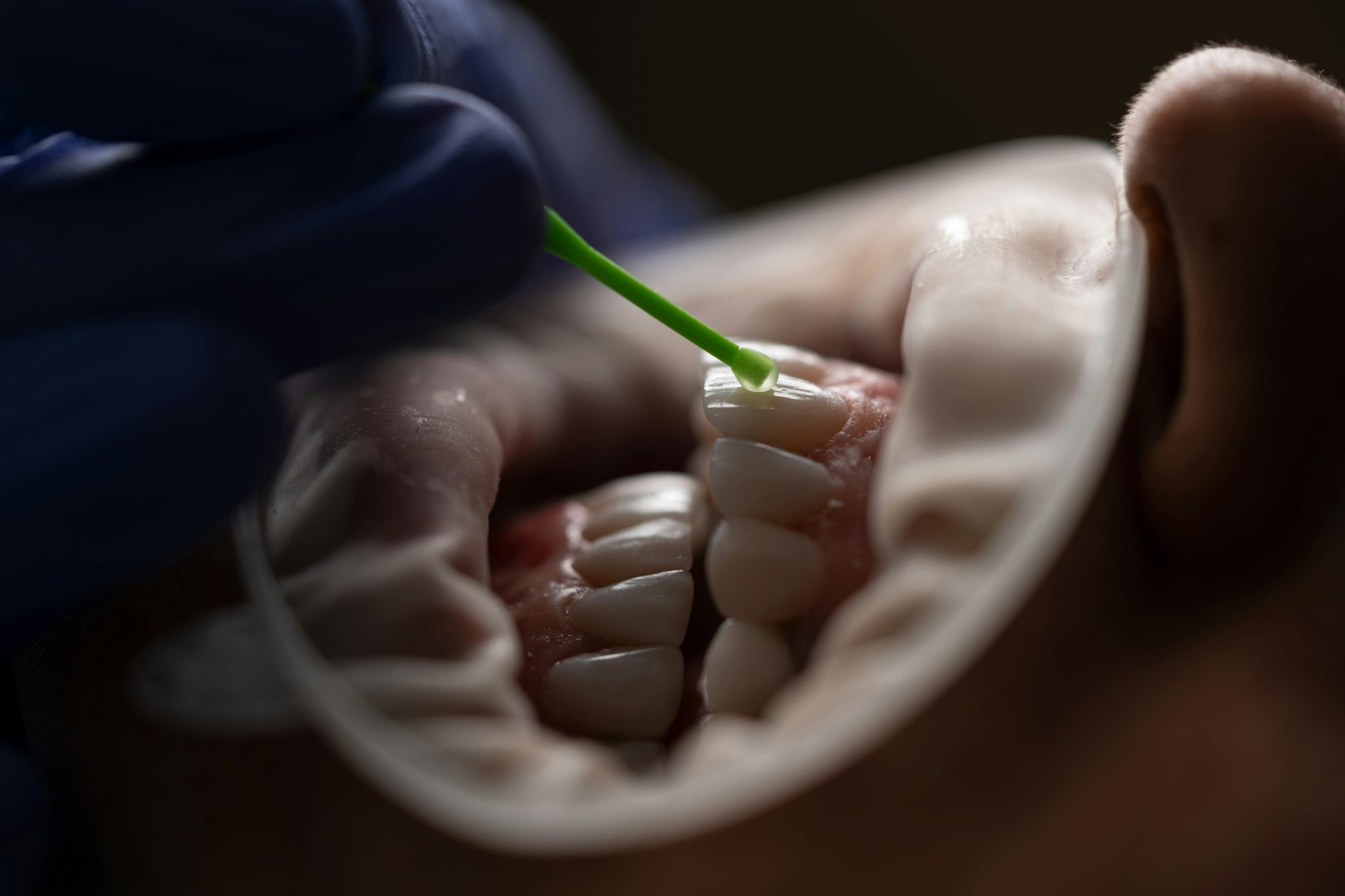 Importance of Fluoride Varnish | Dentists in Asheville, NC
